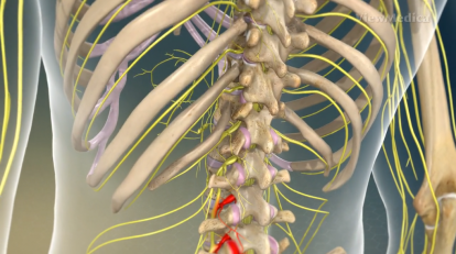 Radiofrequency Lesioning for arthritis | Spine & Pain Institute of New ...